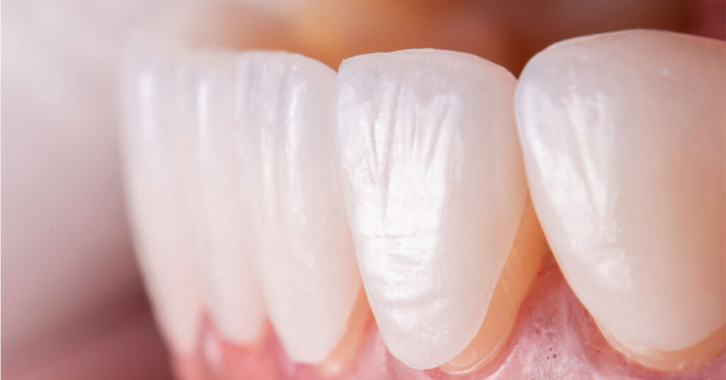 🥇 How Long Do Veneers Last?