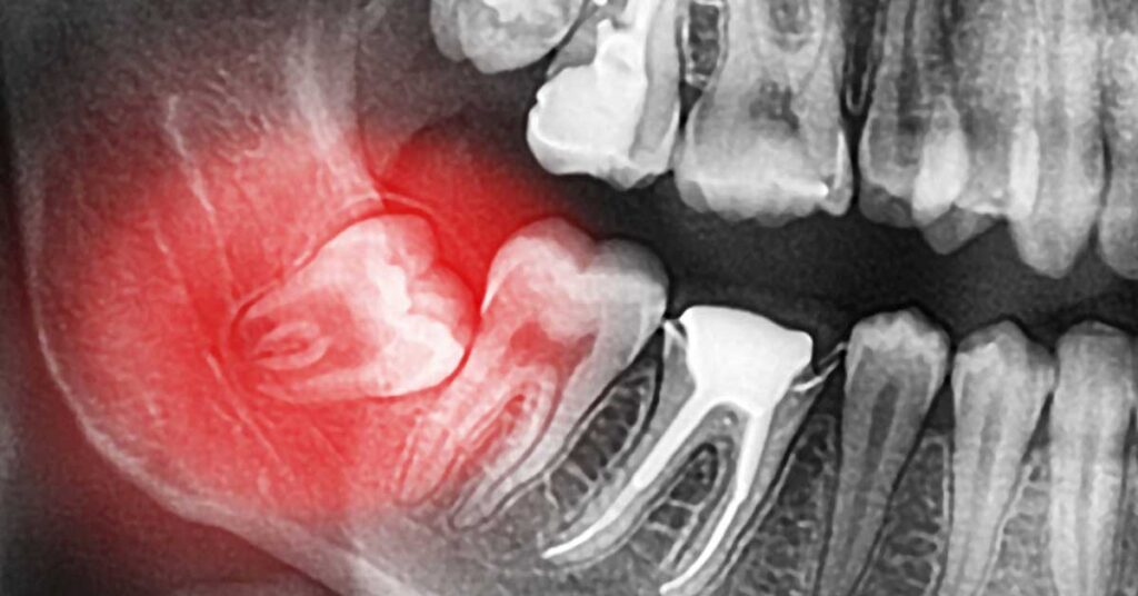🥇 Do Wisdom Teeth Make Your Breath Stink?