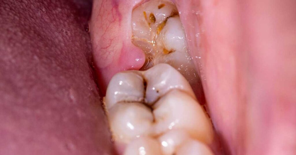 🥇 Do Wisdom Teeth Make Your Breath Stink?